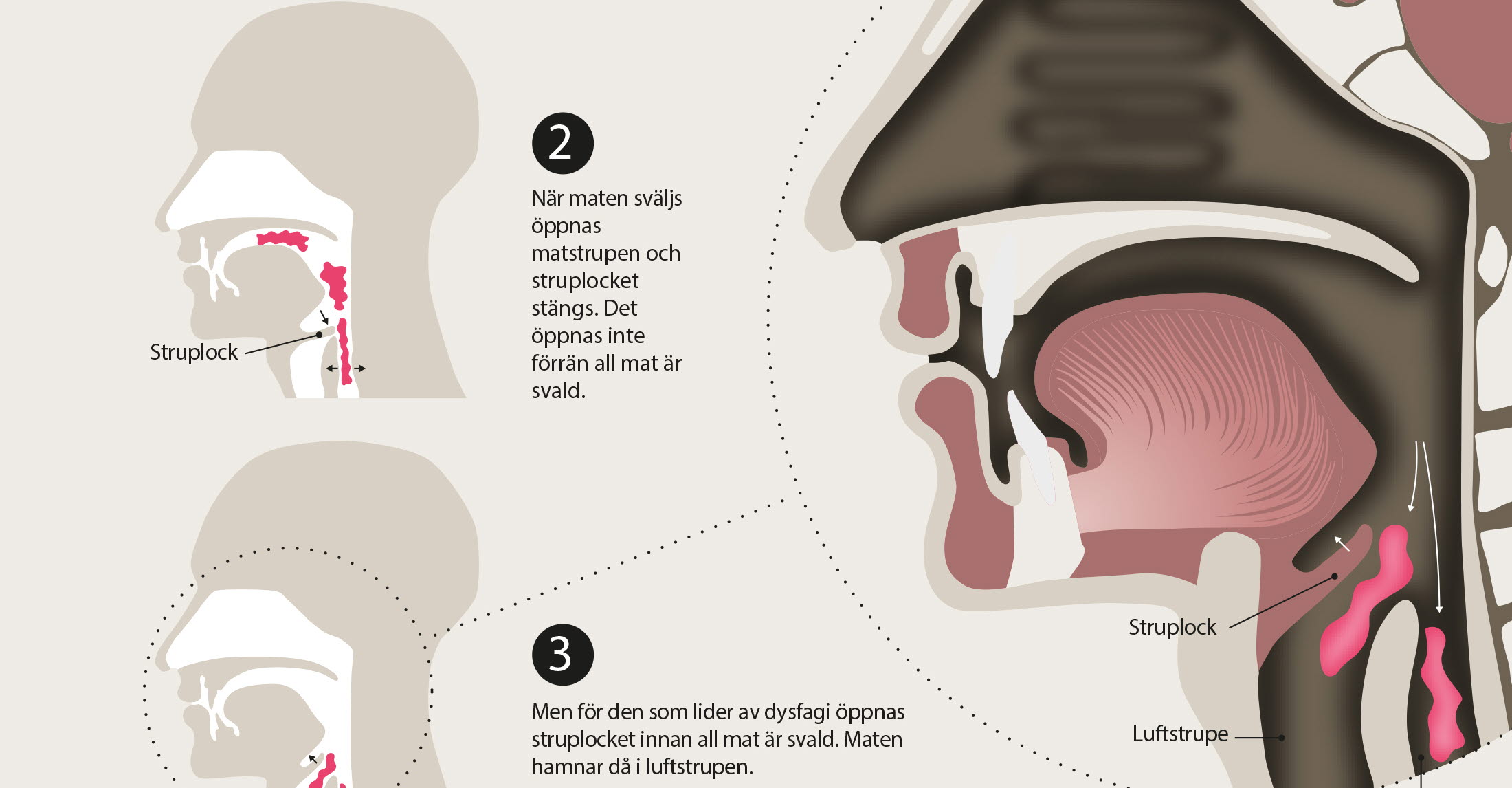 Vården missar dysfagi